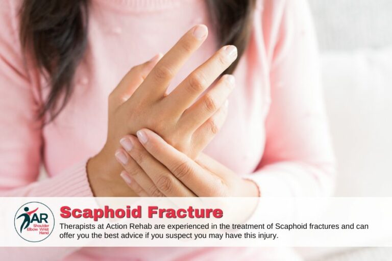 How to treat a Scaphoid fracture - Action Rehab
