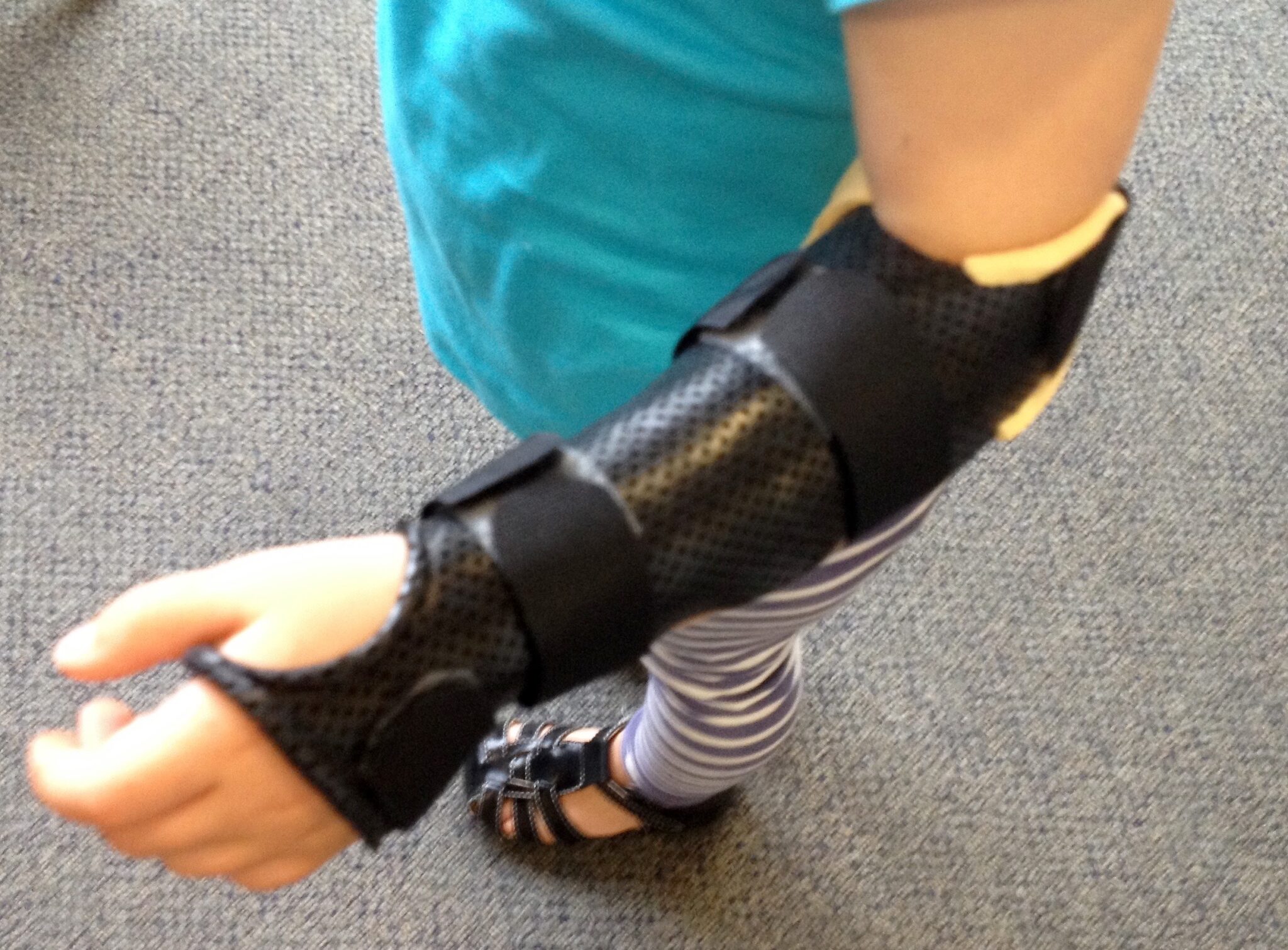 Dislocated Elbow Treatment Melbourne & Gippsland