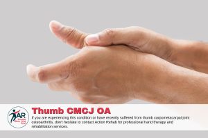Thumb Carpometacarpal Joint Osteoarthritis - Action Rehab