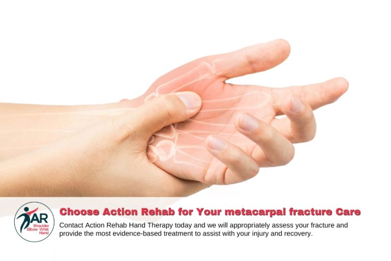 Metacarpal Fractures: Causes and Recovery | Action Rehab