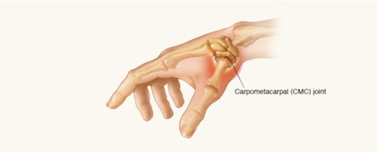How Hand Therapists Can Help with CMC Joint Osteoarthritis (OA ...